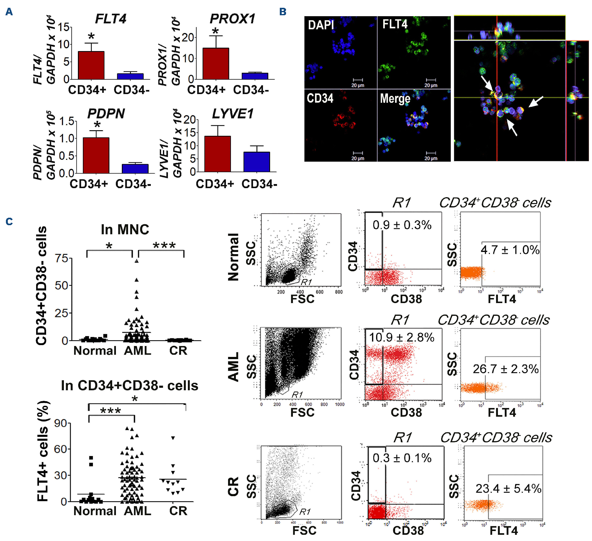 FLT4 as a marker for predicting prognostic risk of refractory acute ...